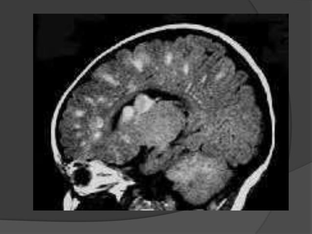 Neurocutaneous syndromes | PPTX