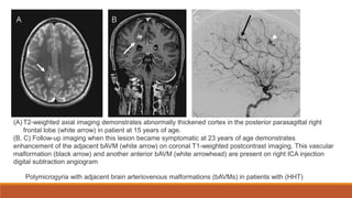 Neurocutaneous syndromes | PPTX