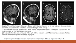 Neurocutaneous syndromes | PPTX