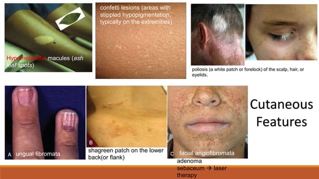 Neurocutaneous syndromes | PPTX | Brain and Nervous System Disorders ...