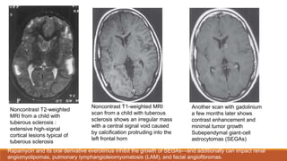 Neurocutaneous syndromes | PPTX