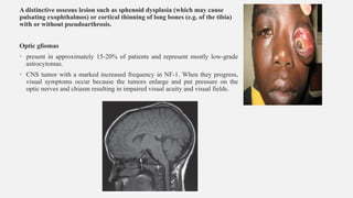 Neurocutaneous syndromes.pptx