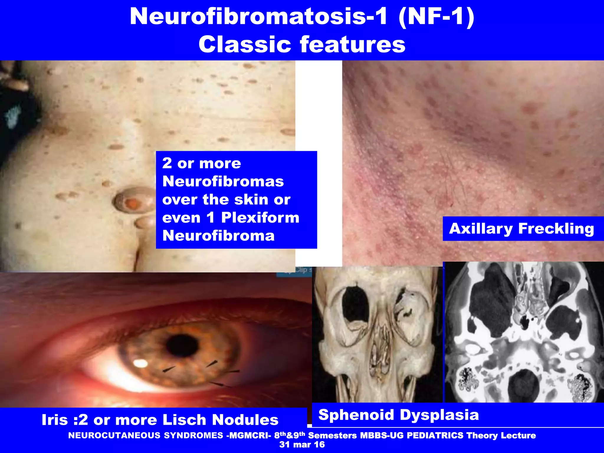 Neurocutaneous Markers and Congenital malformations - Dr. S. Srinivasan ...