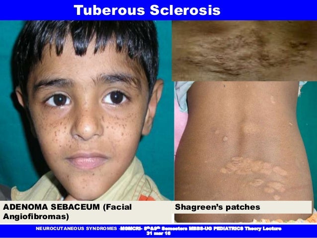 Neurocutaneous Markers and Congenital malformations - Dr. S. Srinivas…