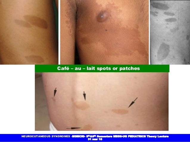 Neurocutaneous Markers and Congenital malformations - Dr. S. Srinivas…