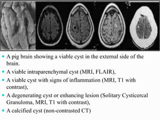 Neurocysticercosis | PPTX