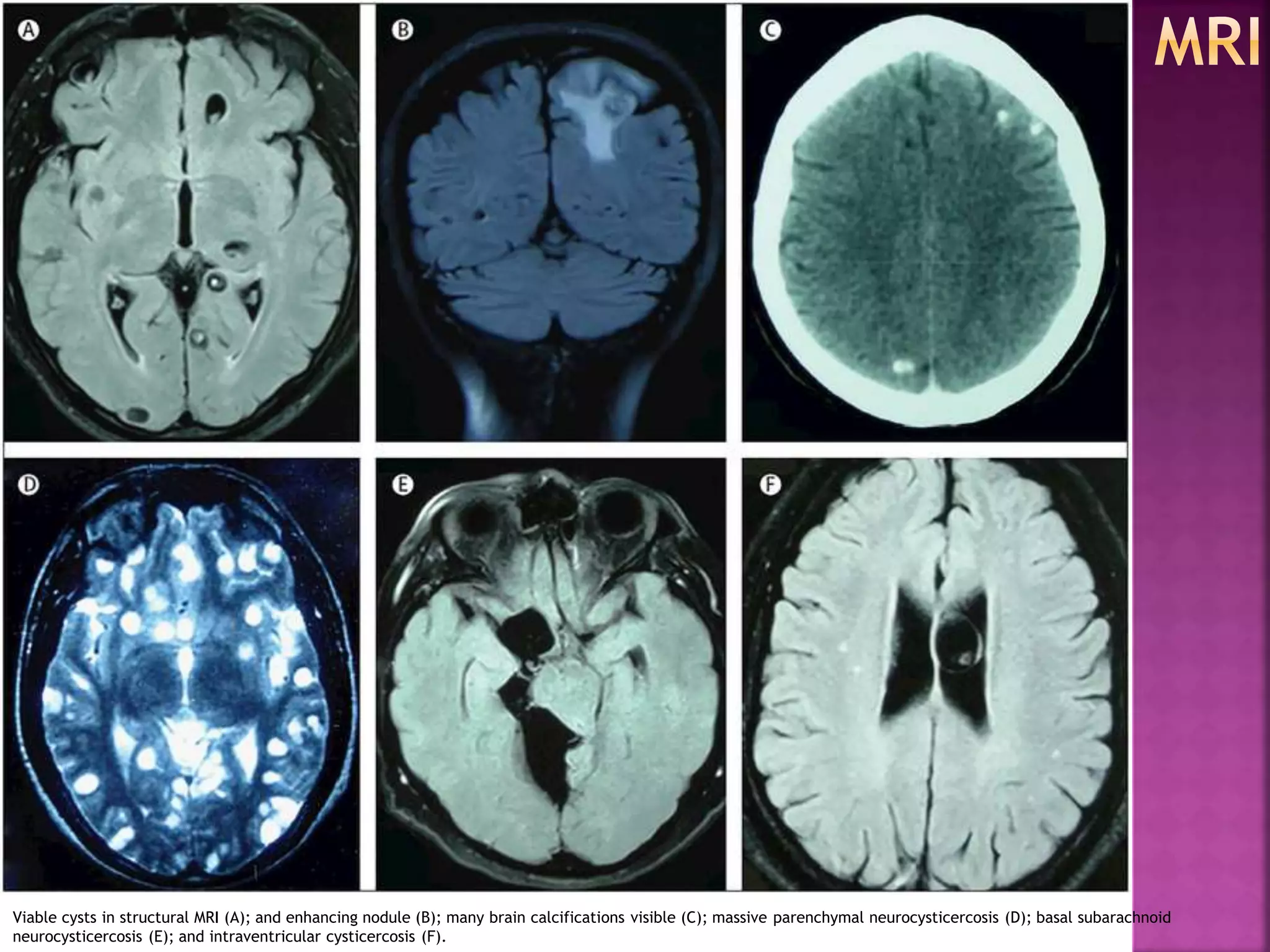 Neurocysticercosis | PPTX