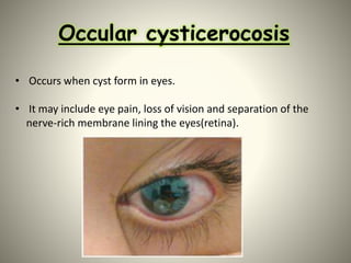 Neurocysticercosis | PPTX