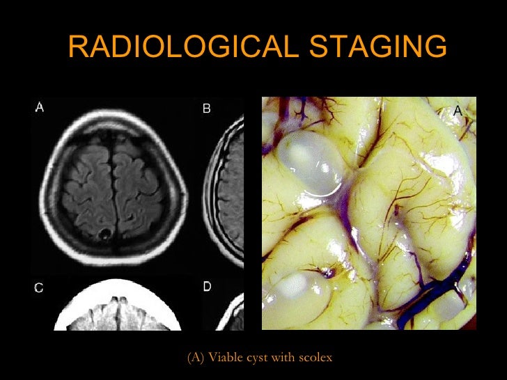 Neurocysticercosis