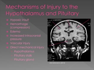 Neuroendocrine dysfunction following traumatic brain injury | PPT