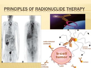 Understanding GEP NET Cancer | PPTX