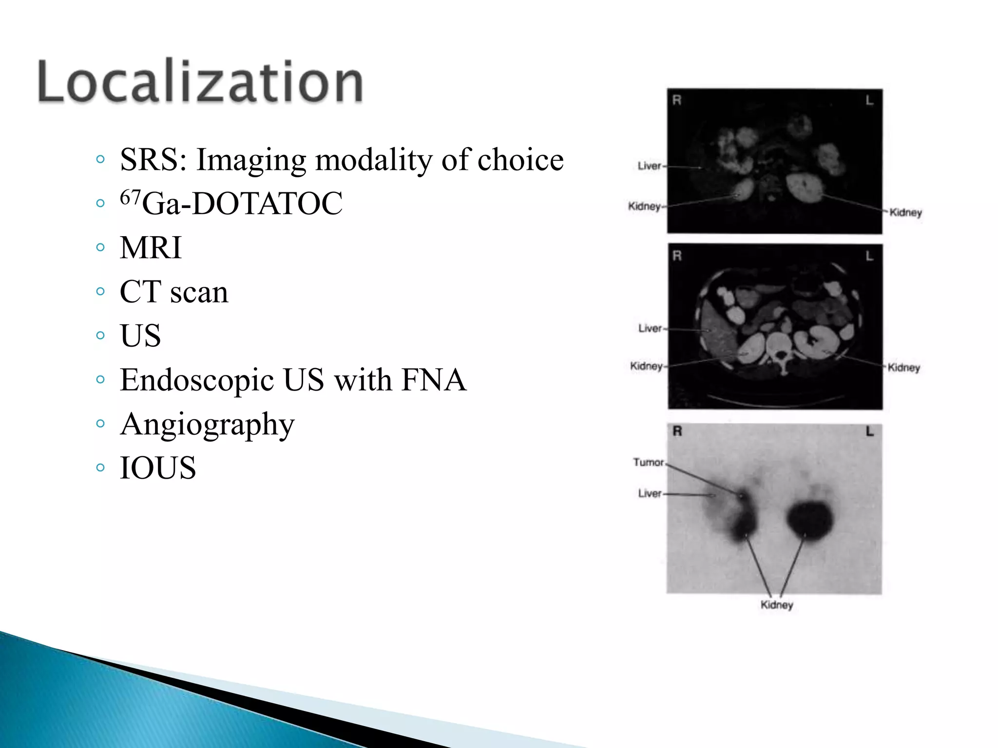 Neuroendocrine tumors of pancreas | PPTX