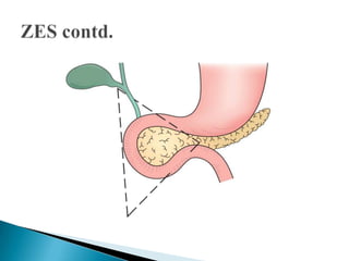 Neuroendocrine tumors of pancreas | PPTX