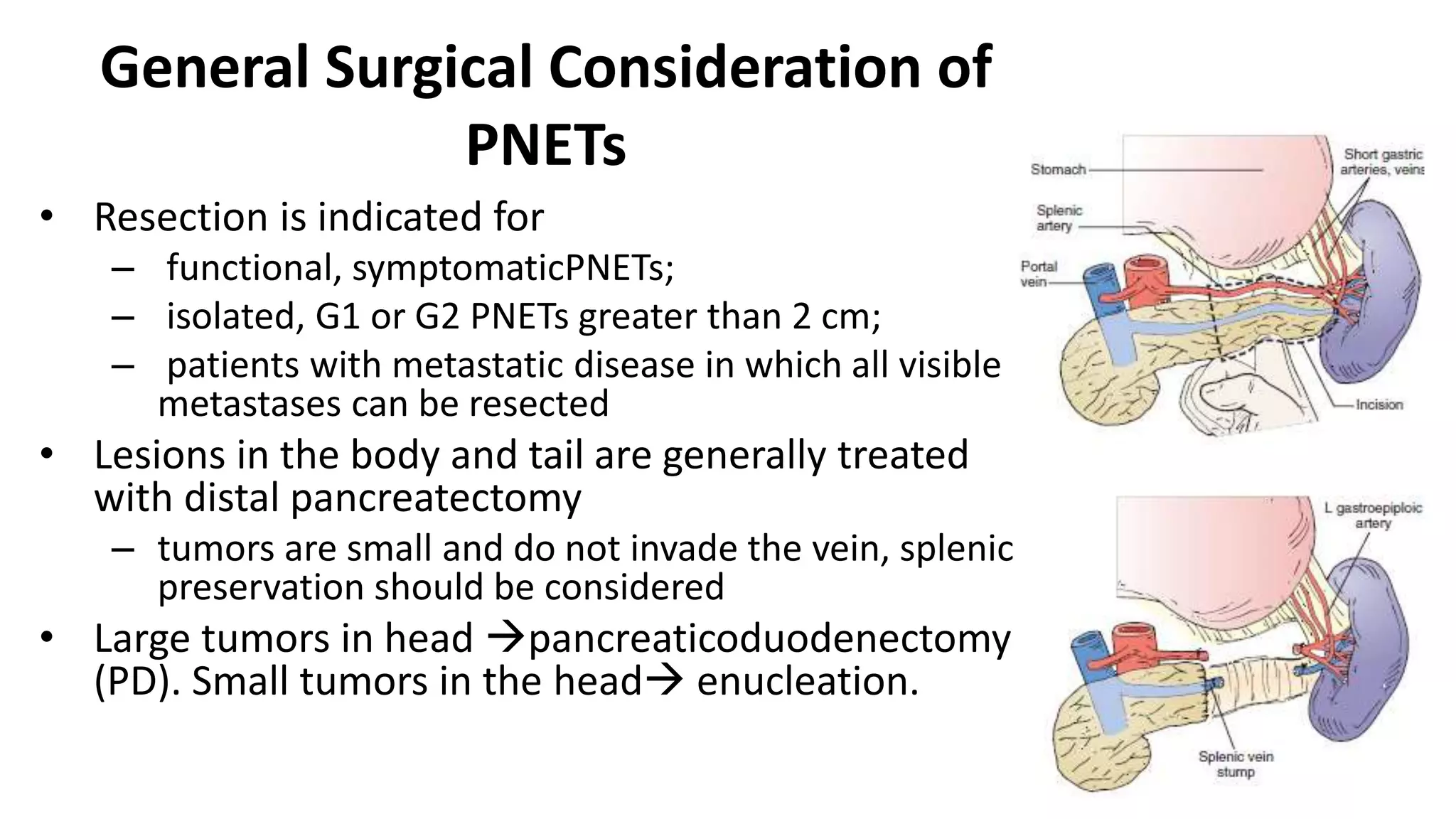 Neuroendocrine tumors of pancreas | PPTX