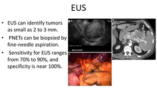 Neuroendocrine tumors of pancreas | PPTX