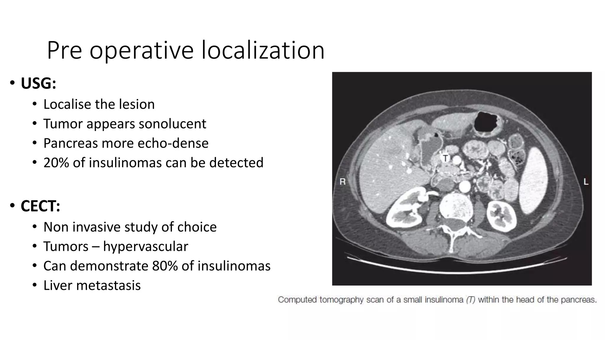 NEUROENDOCRINE TUMORS OF PANCREAS.pptx