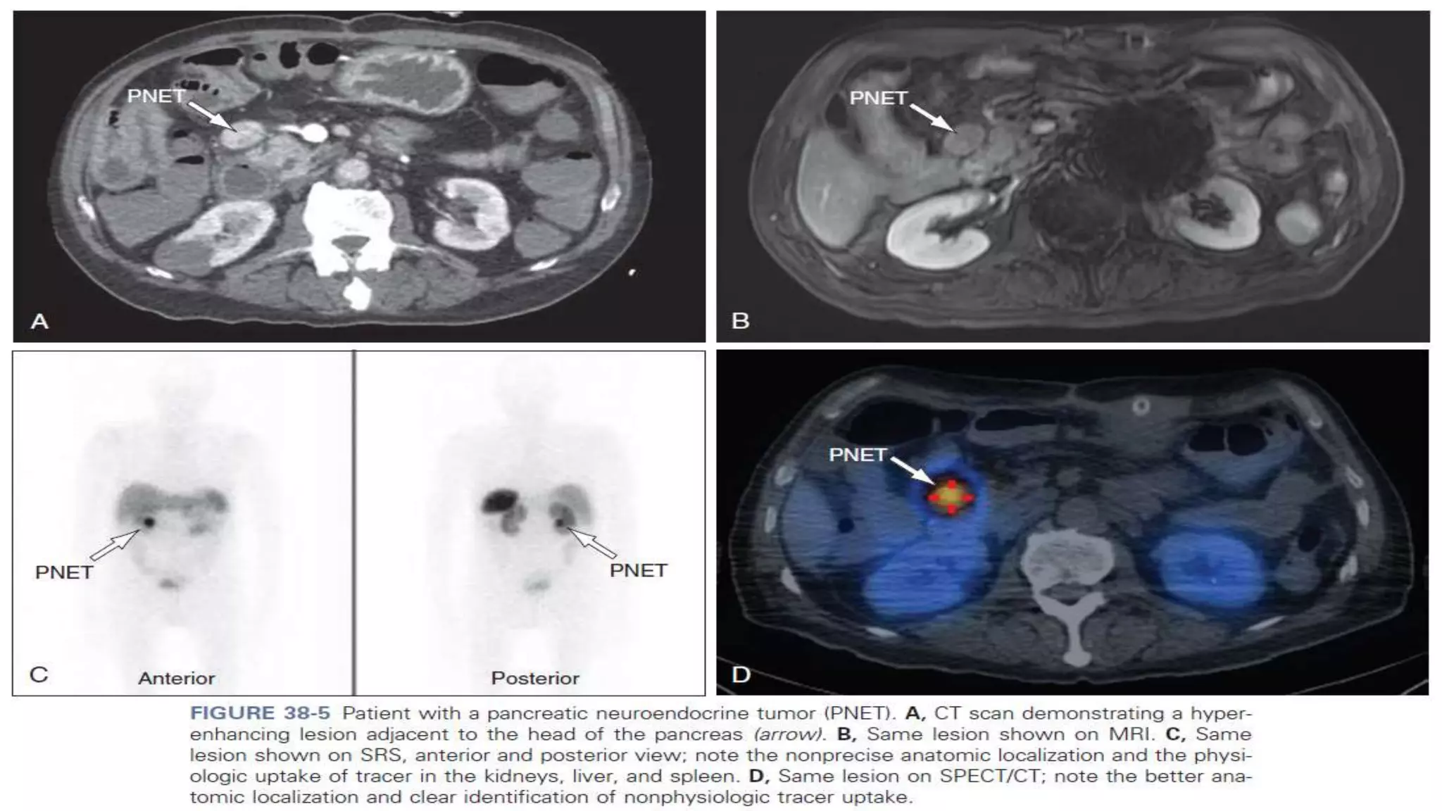 NEUROENDOCRINE TUMORS OF PANCREAS.pptx