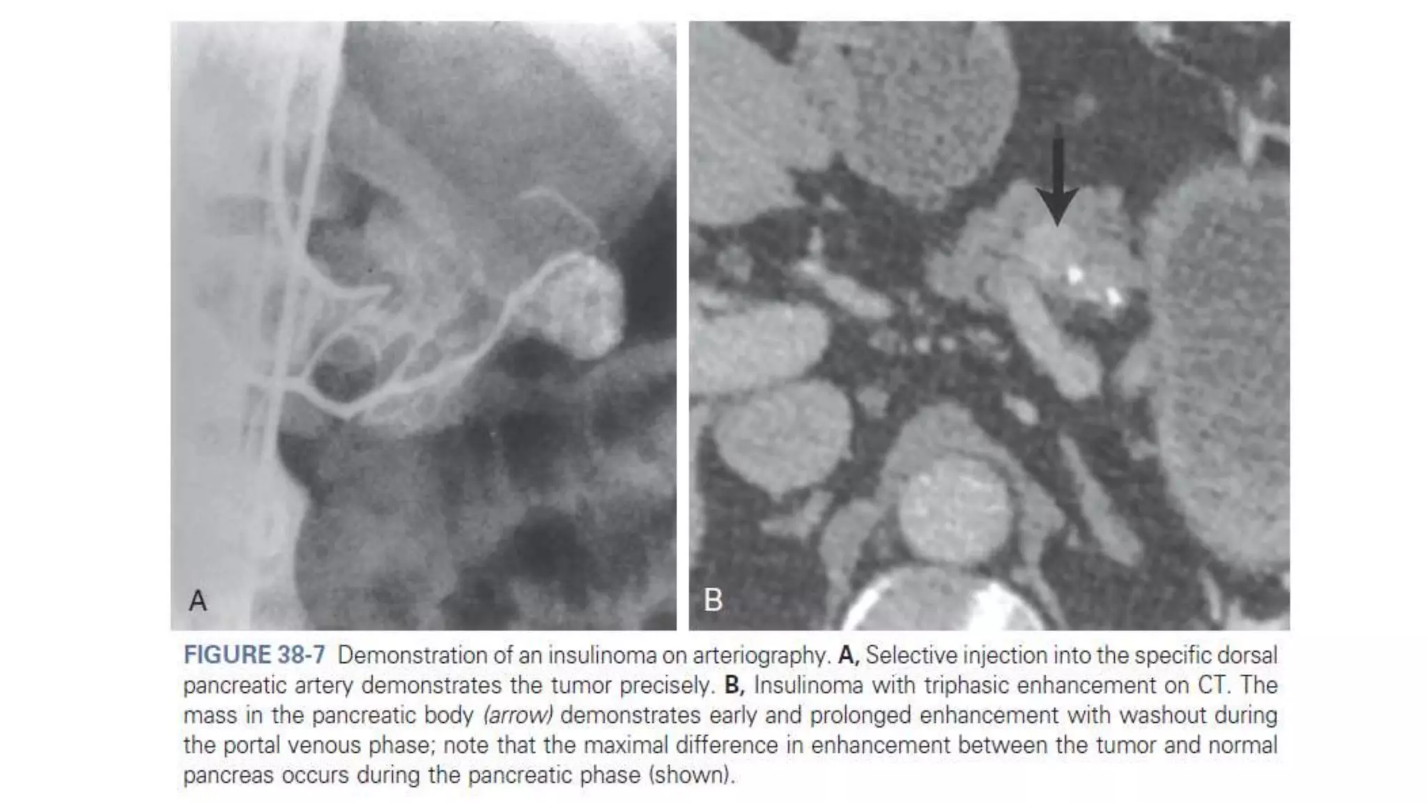 NEUROENDOCRINE TUMORS OF PANCREAS.pptx