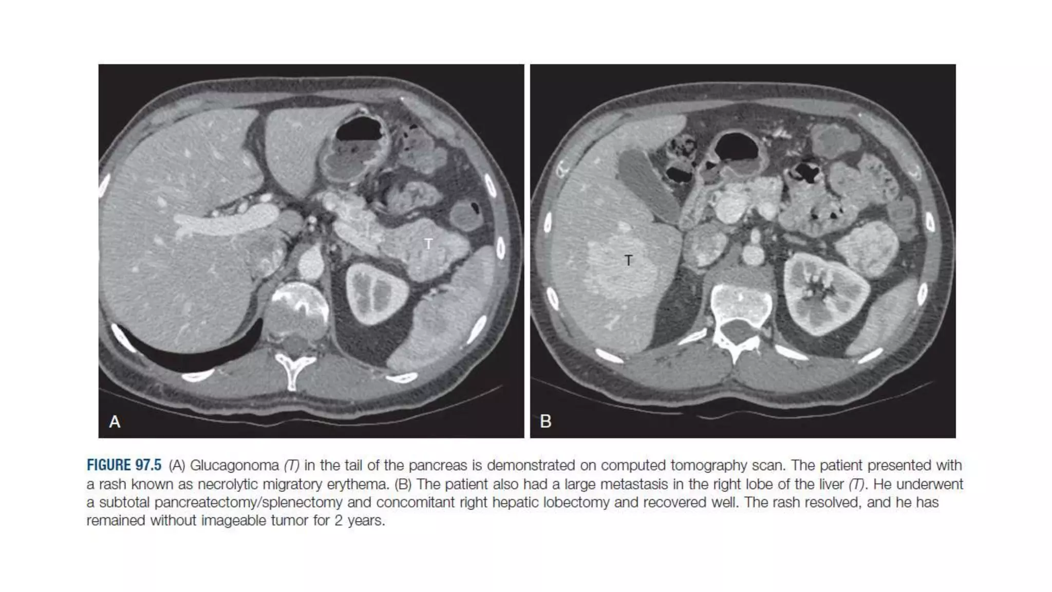 NEUROENDOCRINE TUMORS OF PANCREAS.pptx
