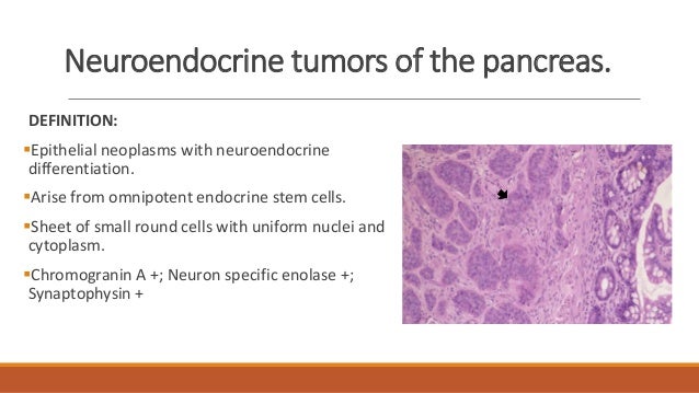 Neuroendocrine tumors of the pancreas