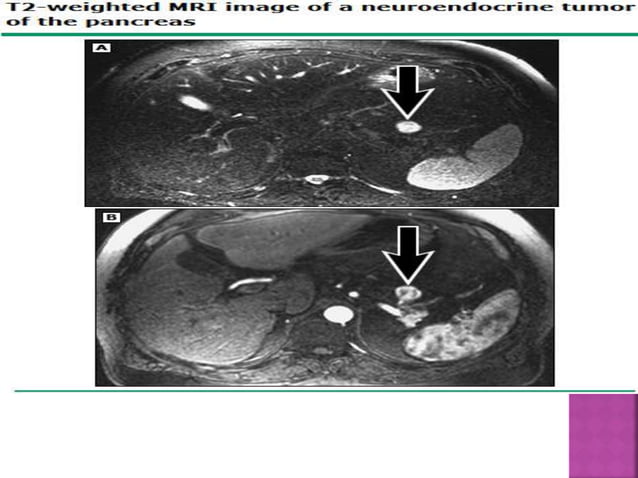 Neuroendocrine tumors of the pancreas | PPT