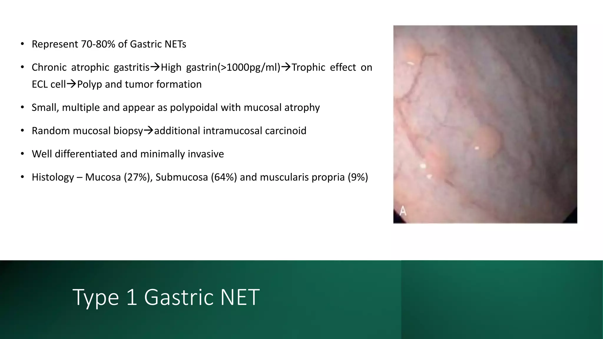 Neuroendocrine tumors (Gastroduodenal) | PPTX