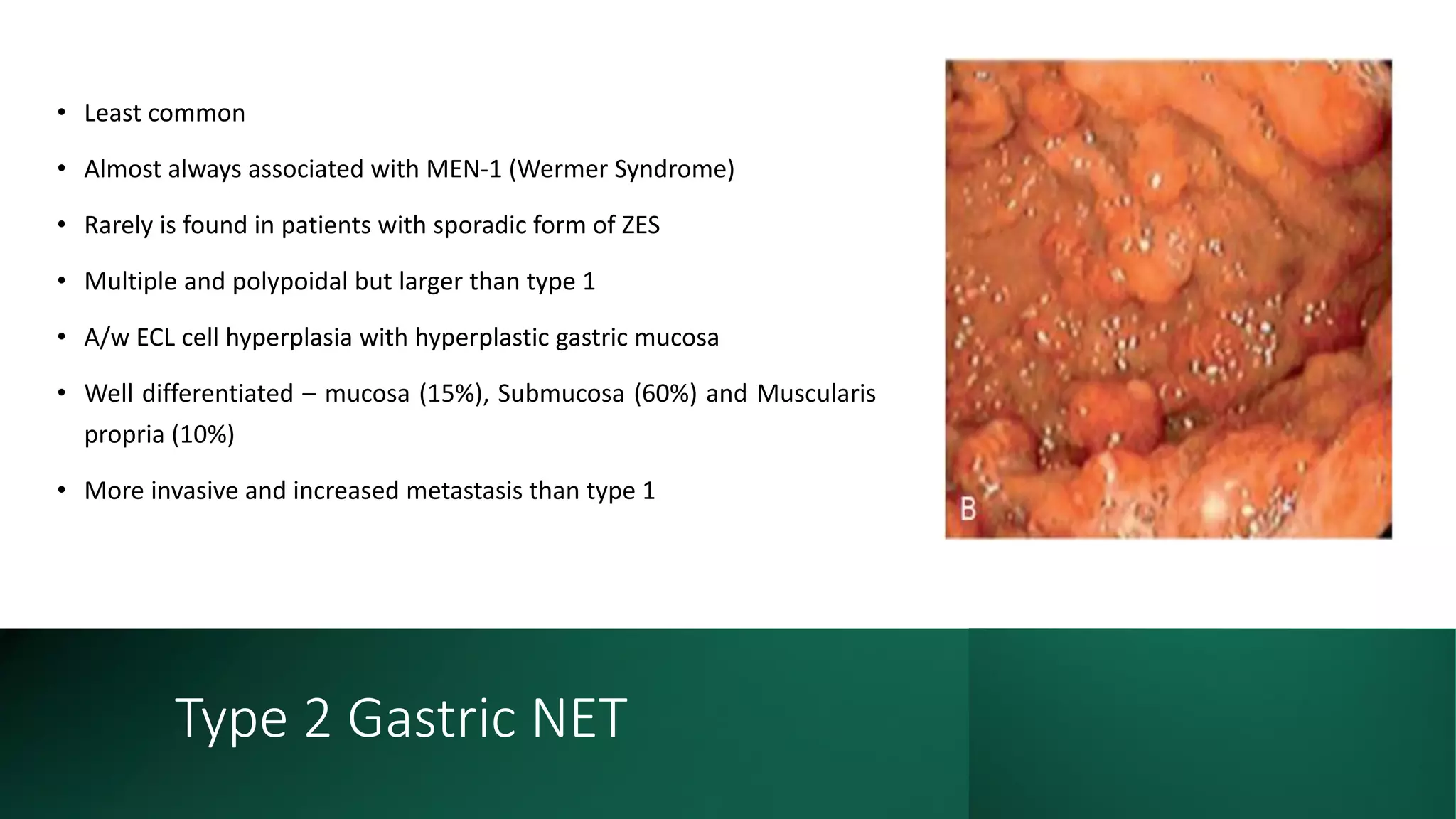 Neuroendocrine tumors (Gastroduodenal) | PPTX