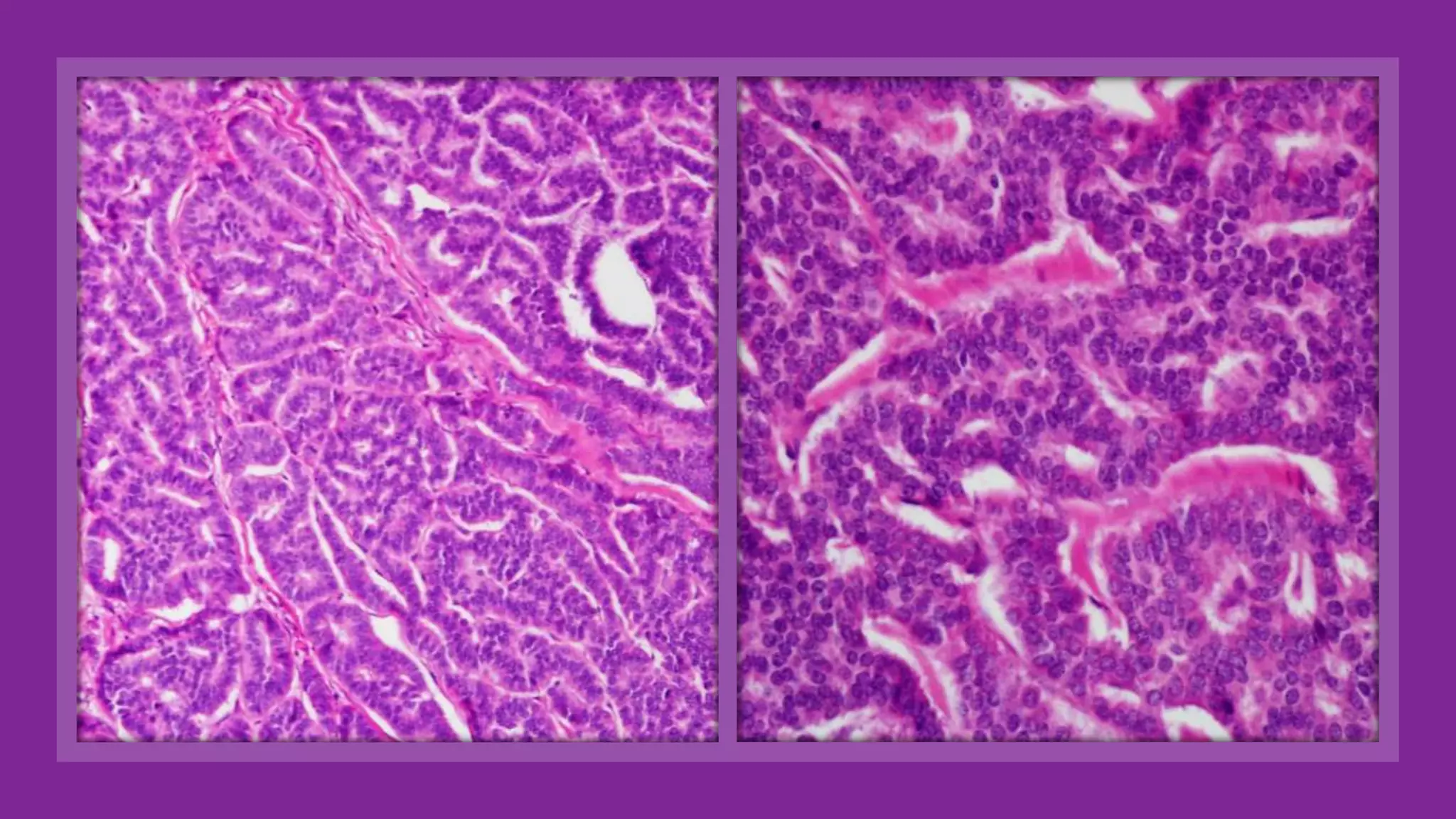 Neuroendocrine tumours.pptx