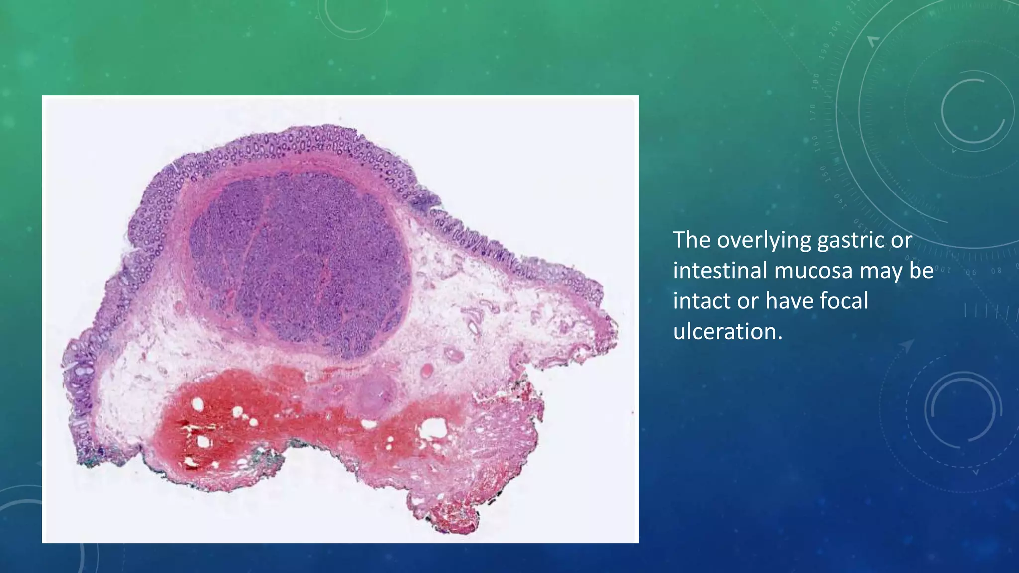 Neuroendocrine tumours.pptx
