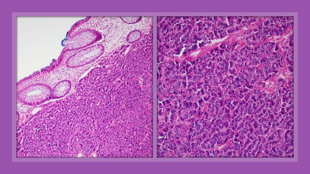 Neuroendocrine tumours.pptx | Endocrine and Metabolic Diseases ...