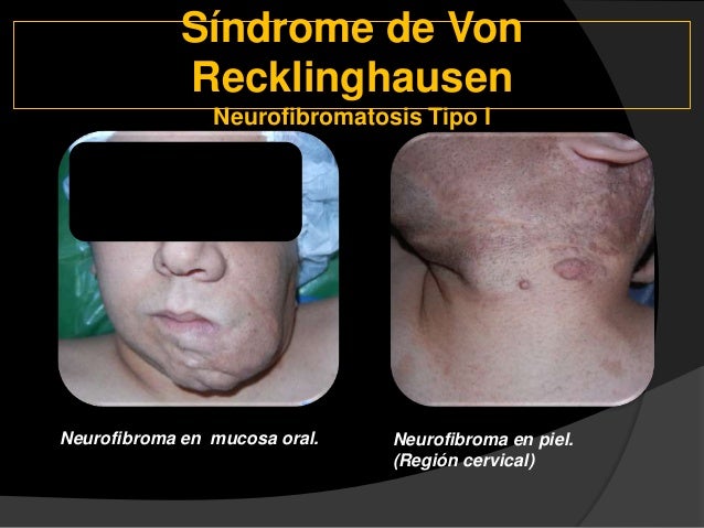 Neurofibroma caso clinico