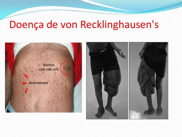 Doença de von Recklinghausen's ( Neurofibromatose Tipo I )