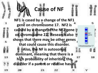 Neurofibromatosis | PPT