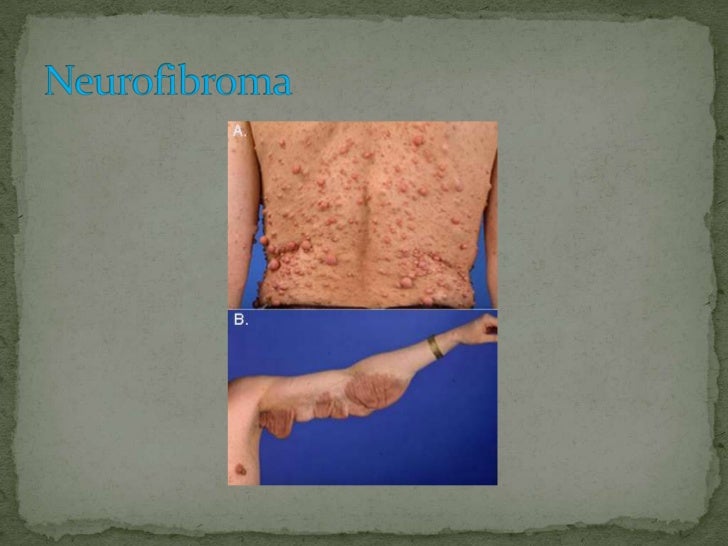 Neurofibromatosis