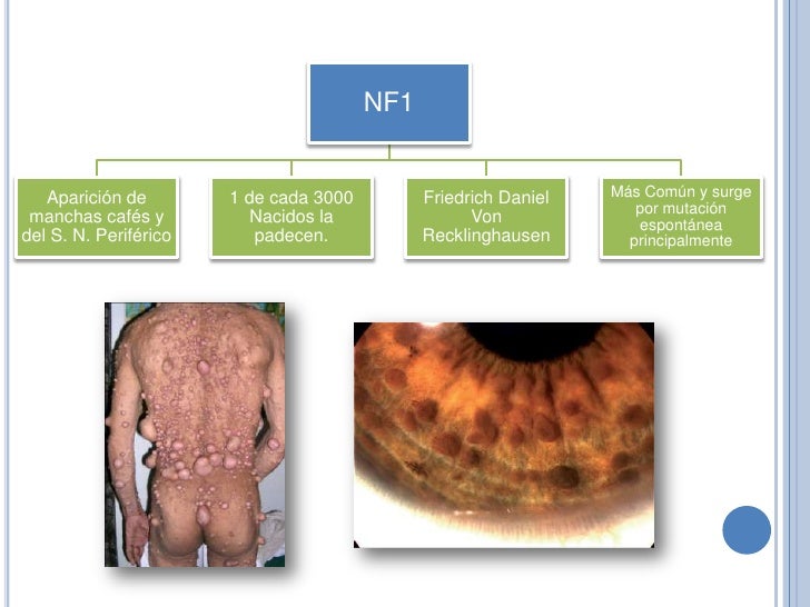 Neurofibromatosis