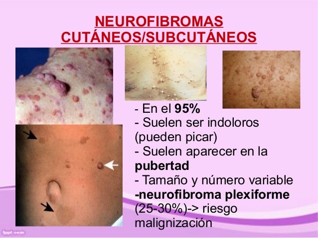 Neurofibromatosis