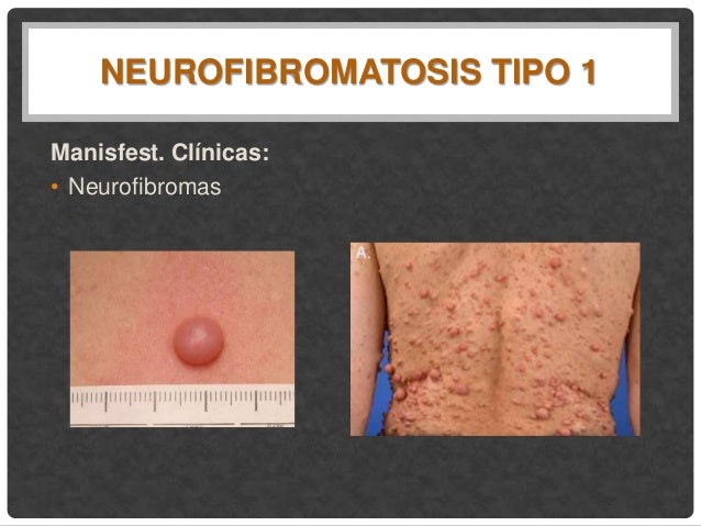 Neurofibromatosis
