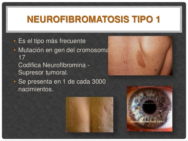 Neurofibromatosis