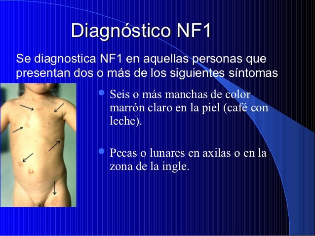 Neurofibromatosis Qu Es Salud Al Da Meningitis, qué es - Salud al día