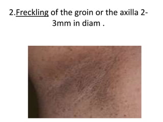 Neurofibromatosis abhijeet | PPTX