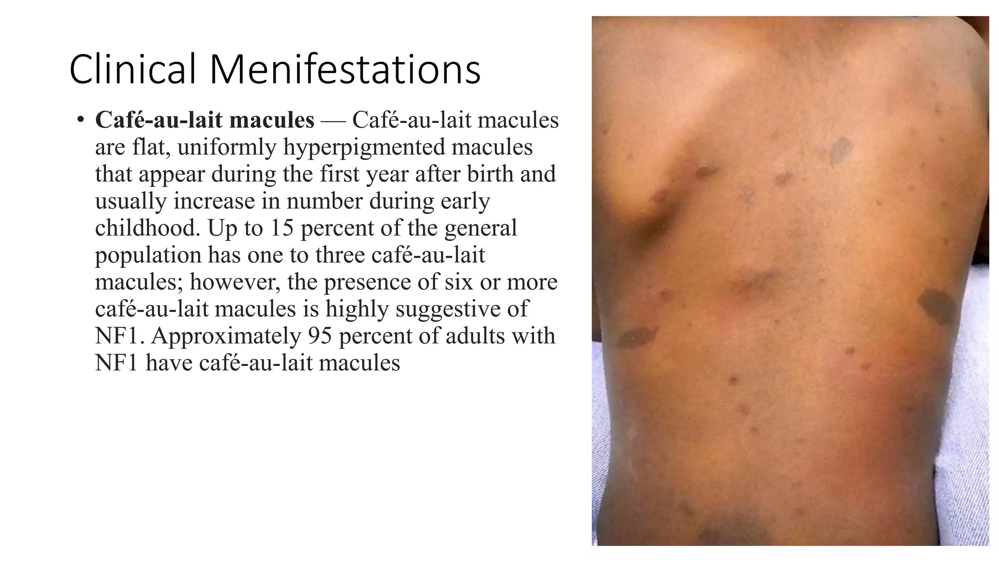 Neurofibromatosis.pptx