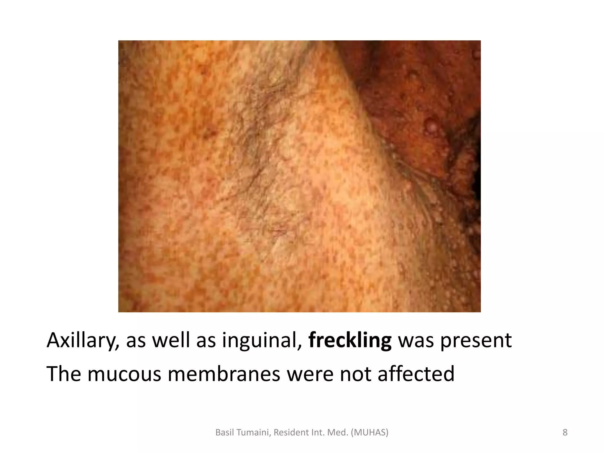 Neurofibromatosis by Dr. Basil Tumaini | PPTX