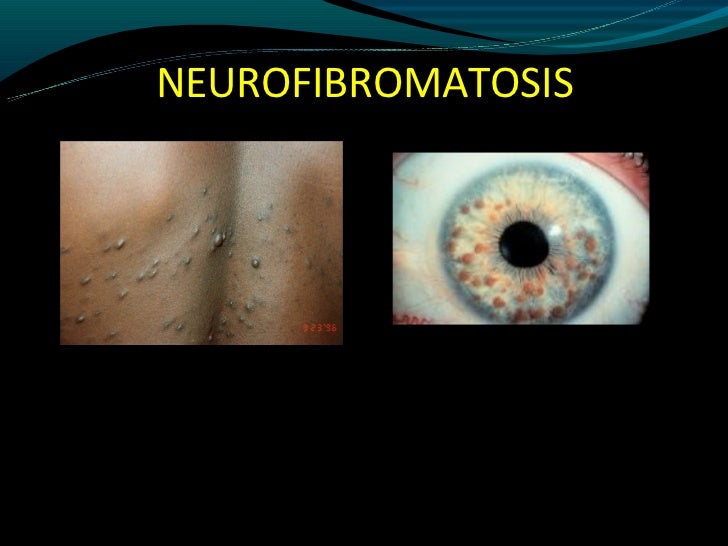 Neurofibromatosis o enfermedad de von recklinghausen