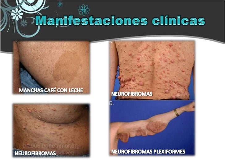 Neurofibromatosis Tipo 1 Enfermedad De Von Recklinghousen