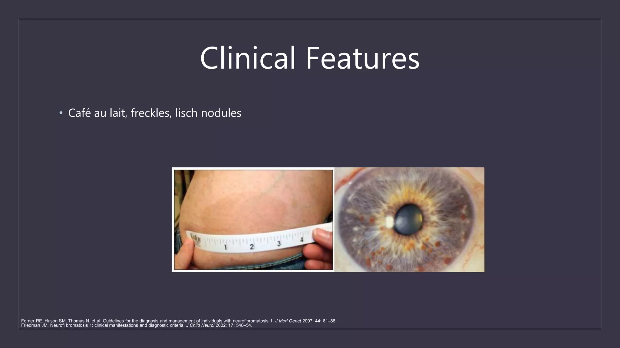 Neurofibromatosis Type I | PPTX