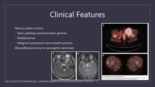 Neurofibromatosis Type I | PPTX