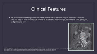 Neurofibromatosis Type I | PPTX