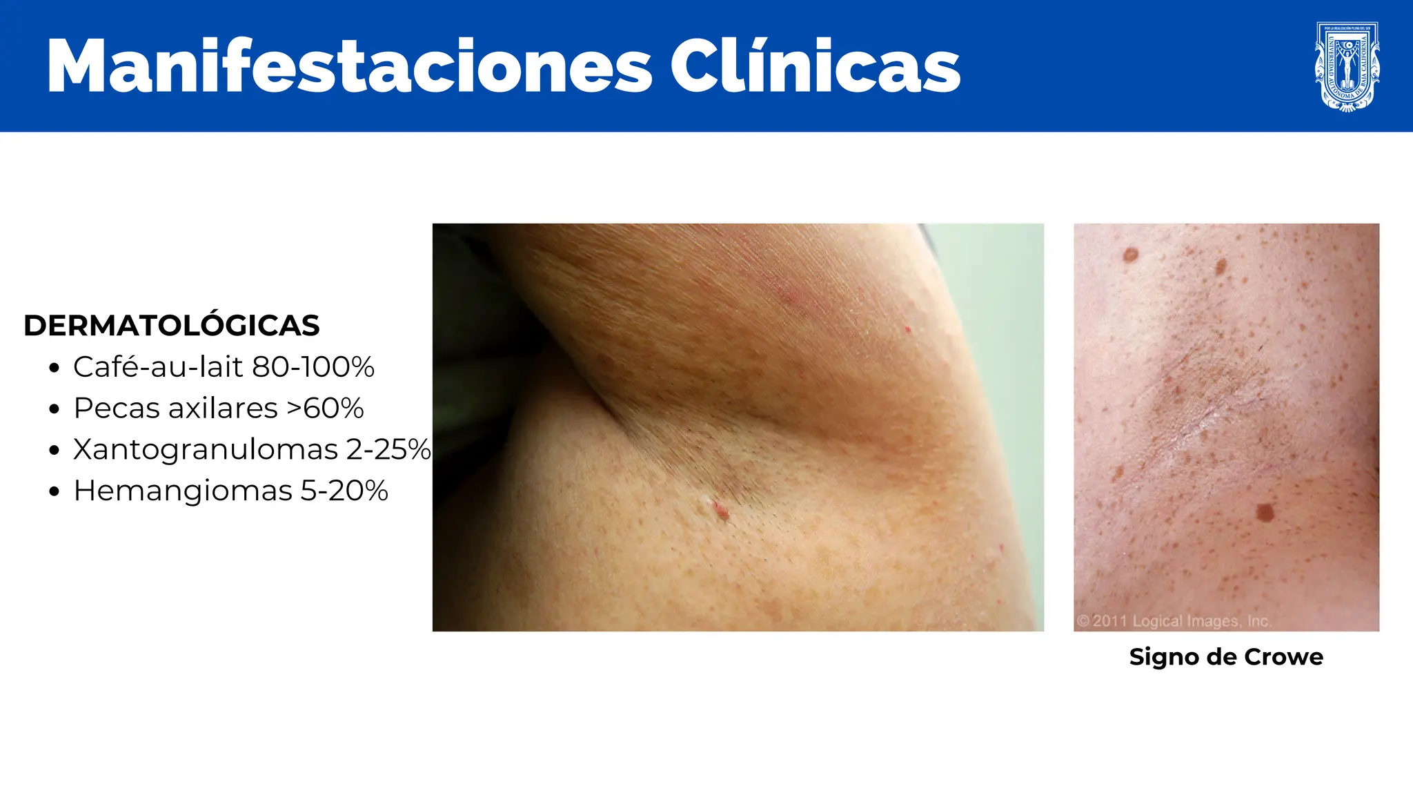 Neurofirbomatosis tipo I - Carranza Herrera Valeria | PDF