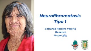 Neurofirbomatosis tipo I - Carranza Herrera Valeria | PPT