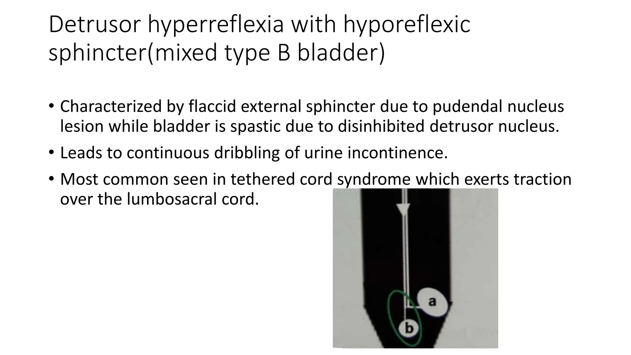 NEUROGENIC BLADDER.pptx